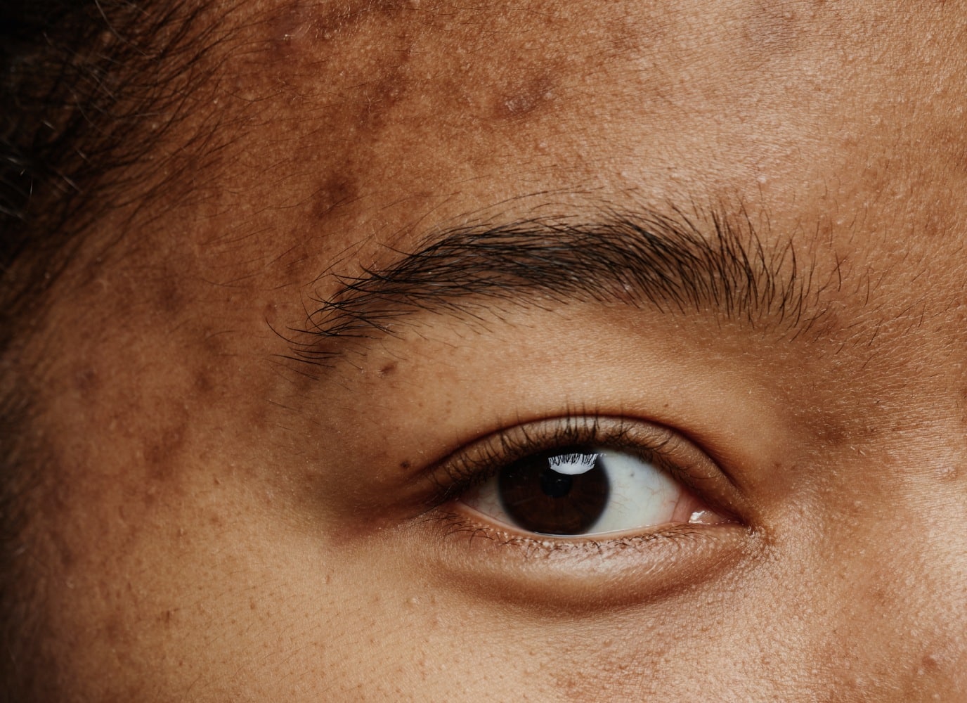 Taches pigmentaires, causes & traitements | Glaze | Argenteuil et Sevran